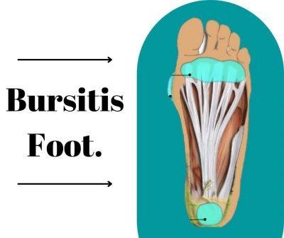 Bursitis Foot | The Prolotherapy Clinic