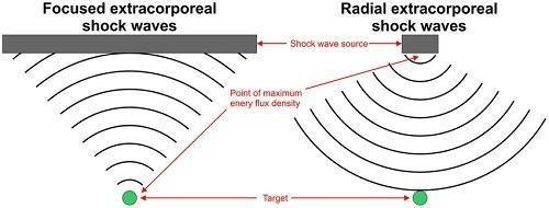 Shockwave Therapy in Pune | The Prolotherapy Clinic