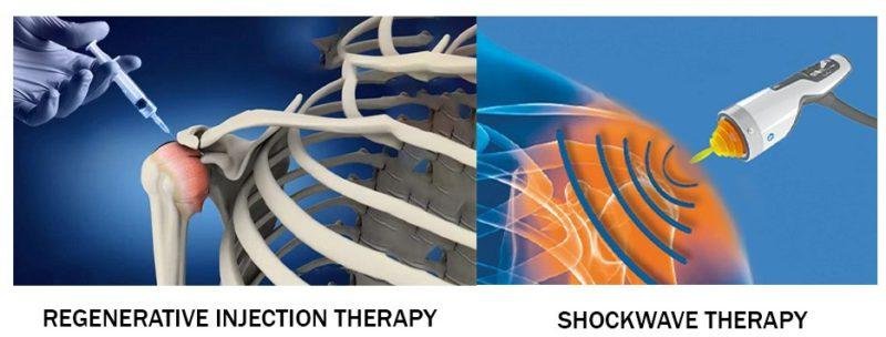 Effective Treatment Options for The Frozen Shoulder