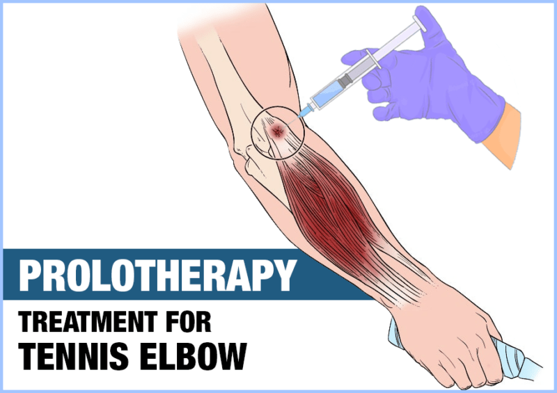 How can Tennis Elbow be Prevented? | The Prolotherapy Clinic